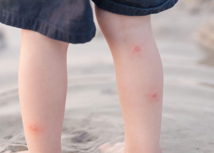 Pomadas que aliviam picadas de insetos rapidamente